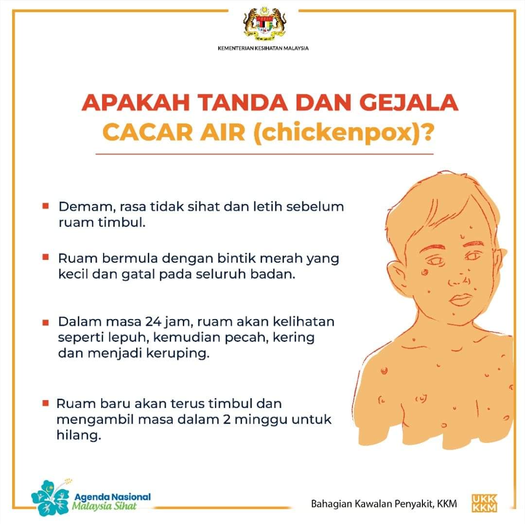 Cacar Air (Chicken Pox): Punca, Tanda, Simptom & Rawatan