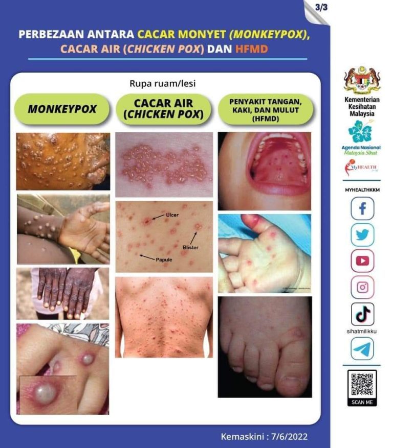 Cacar Air (Chicken Pox): Punca, Tanda, Simptom & Rawatan